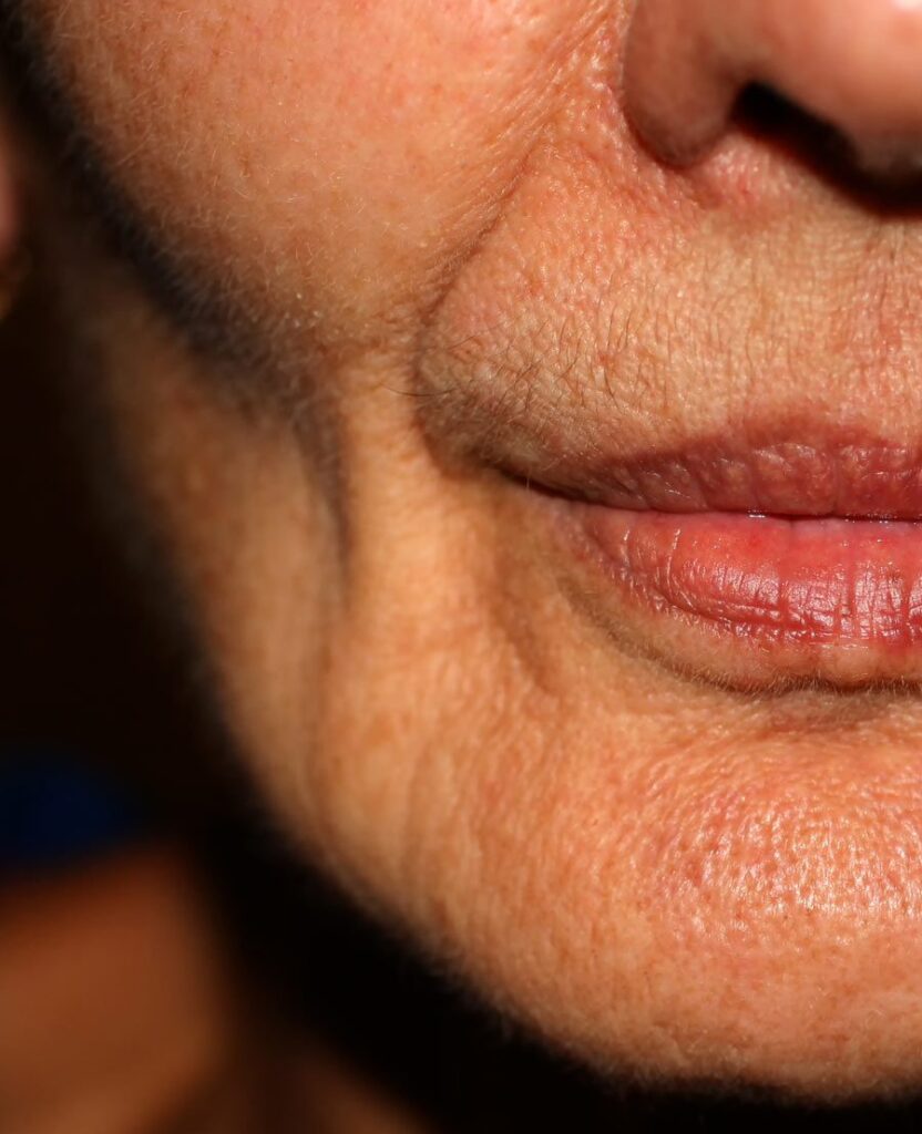 Brow Ptosis and Droopy Eyebrow Treatments at Face Restoration