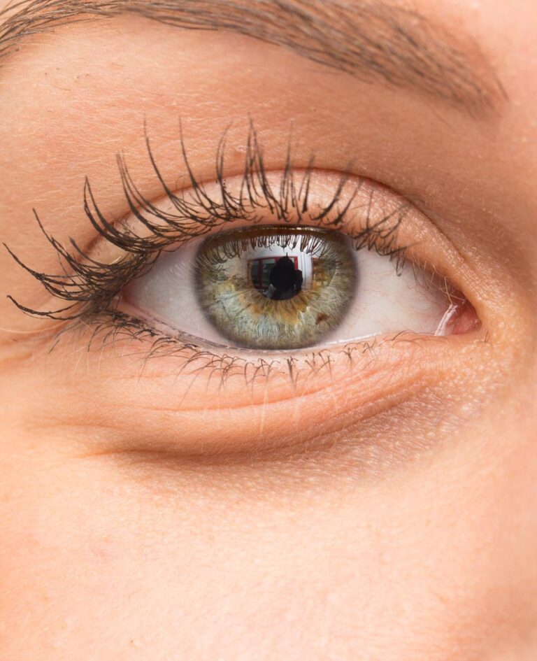 Festoons, Malar Oedema & Lower Lid Eye Bag Treatment | London