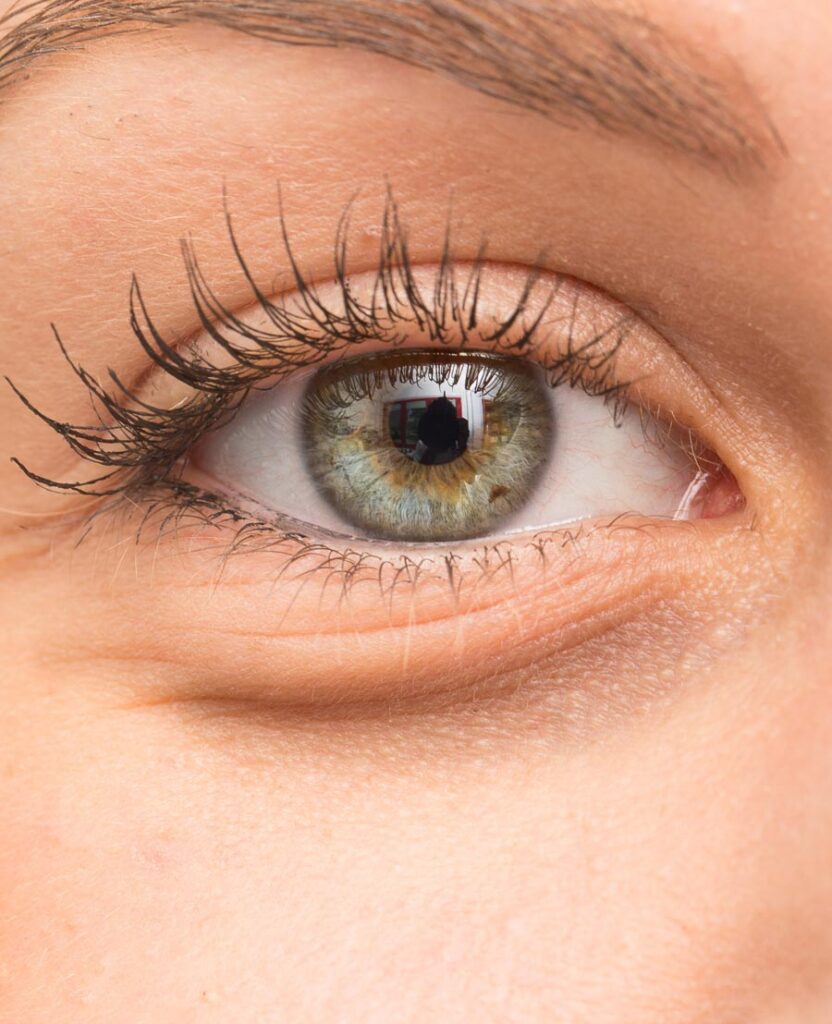 Festoons, Malar Oedema & Lower Lid Eye Bag Treatment | London