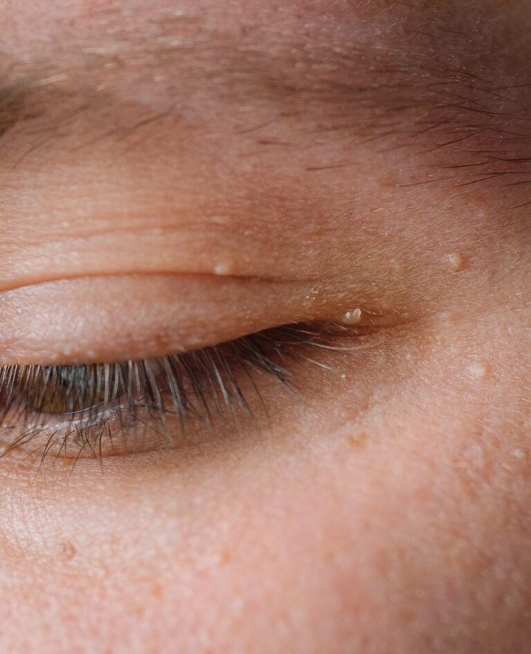 Eyelid Lumps, Bumps & Skin Tags Treatment | Face Restoration