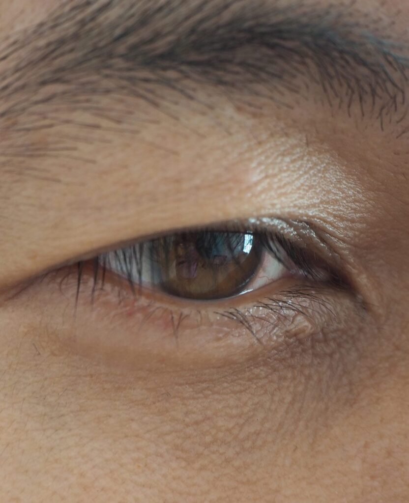 Brow Ptosis and Droopy Eyebrow Treatments at Face Restoration