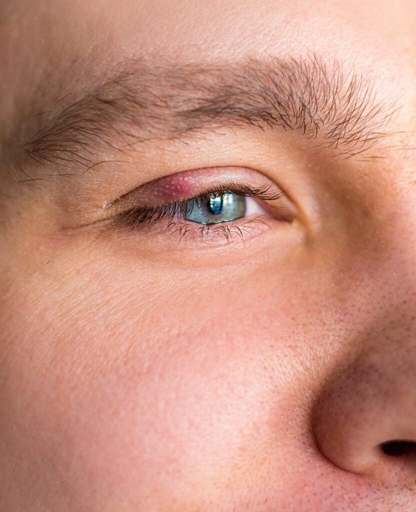 Brow Ptosis and Droopy Eyebrow Treatments at Face Restoration