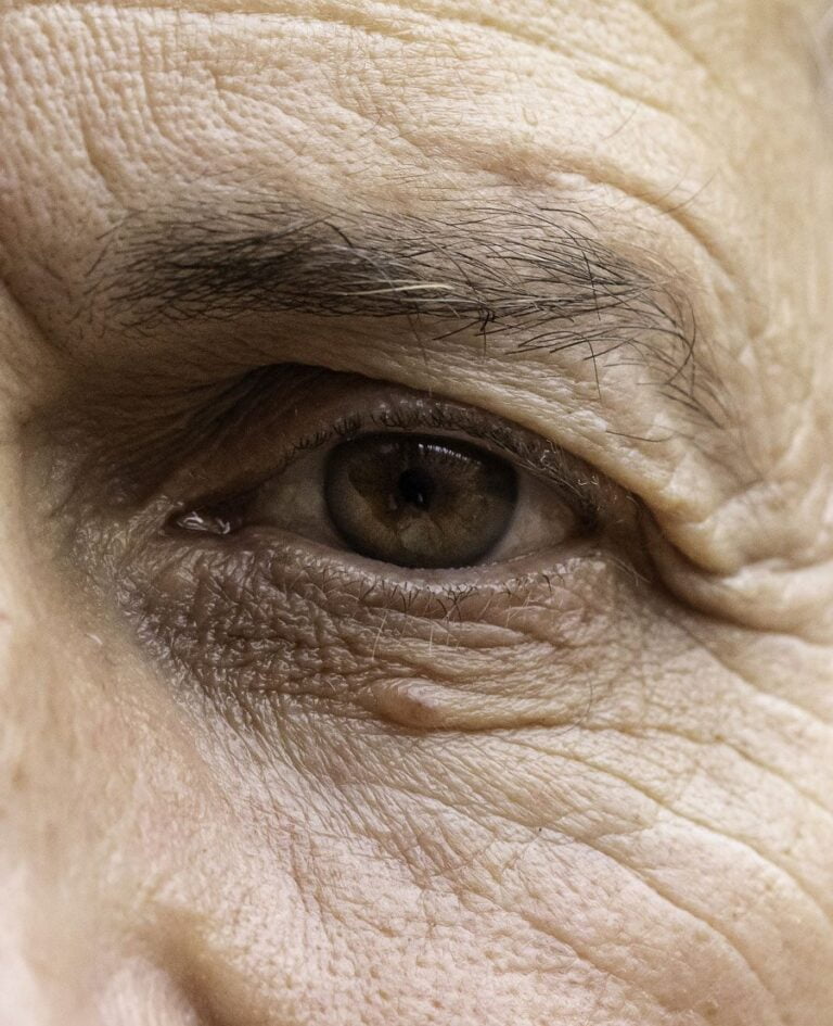 Eyelid Weight Surgery | Close & Protect your Eye | FaceRestoration