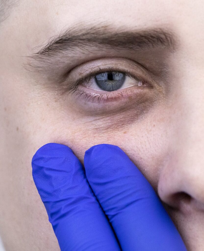 Punctoplasty treatment for Wet & Watery Eyes | Face Restoration